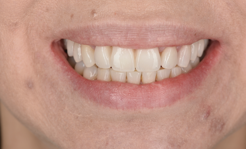 Before & After Dental Photos Sugar Land TX | Smile Gallery