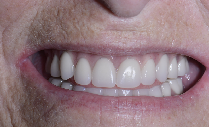 Before & After Dental Photos Sugar Land TX | Smile Gallery